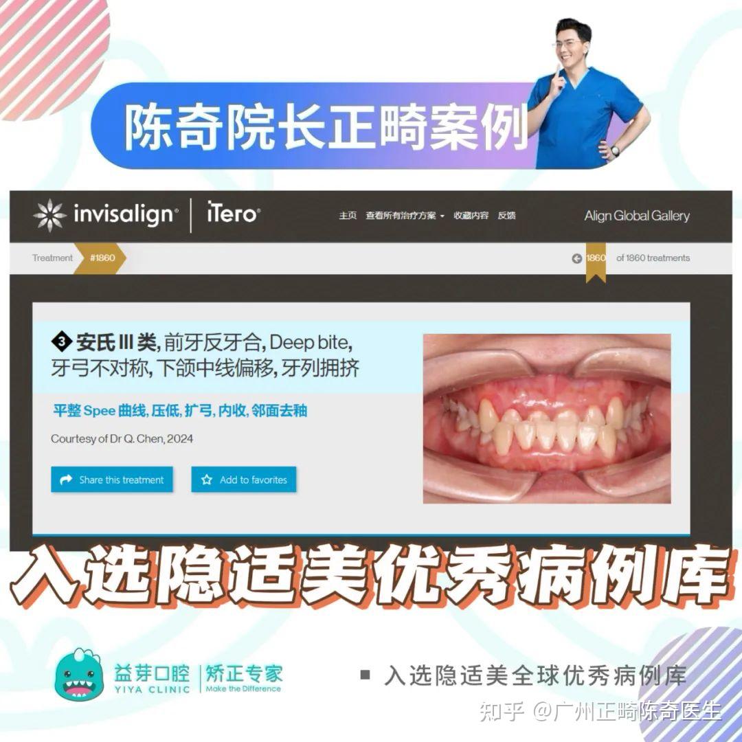 入选Invisalign Global Gallery |成人骨性地包天，非手术+0拔牙+0骨钉，14个月拥有好看侧颜！ - 知乎