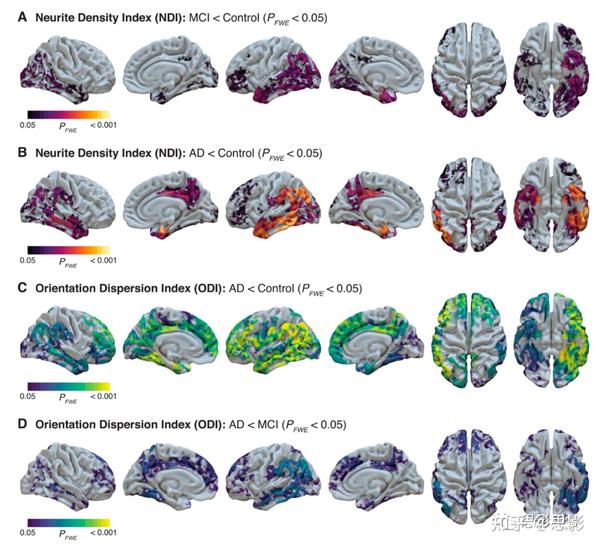 轻度认知障碍与阿尔茨海默病痴呆中皮质微结构改变 - 知乎