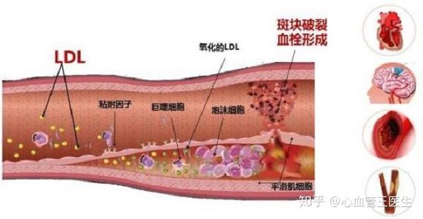 怎样逆转血管斑块 知乎