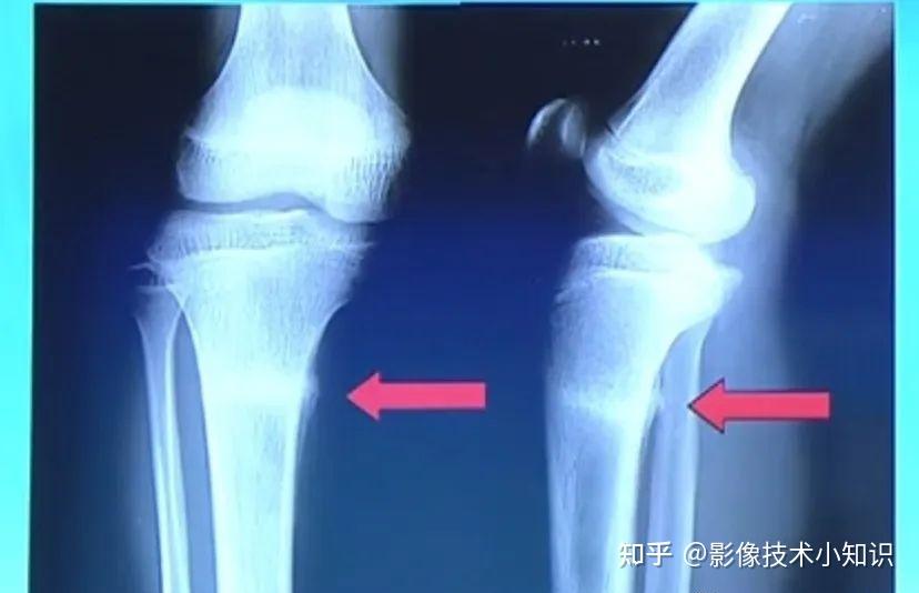 骨折影像表现（1） - 知乎