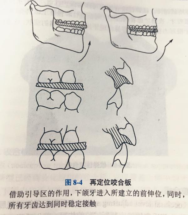 咬合治疗——咬合板治疗 - 知乎