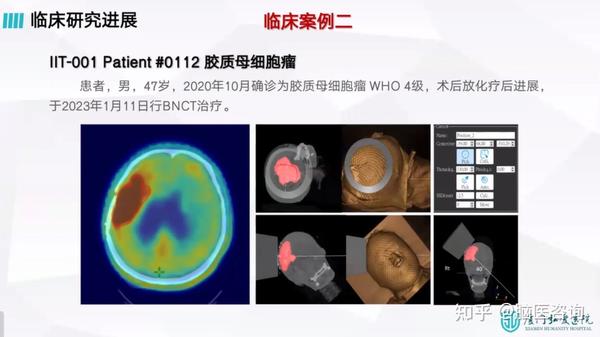 硼中子俘获疗法是什么？对脑胶质瘤效果如何？快来看看专家揭秘 - 知乎