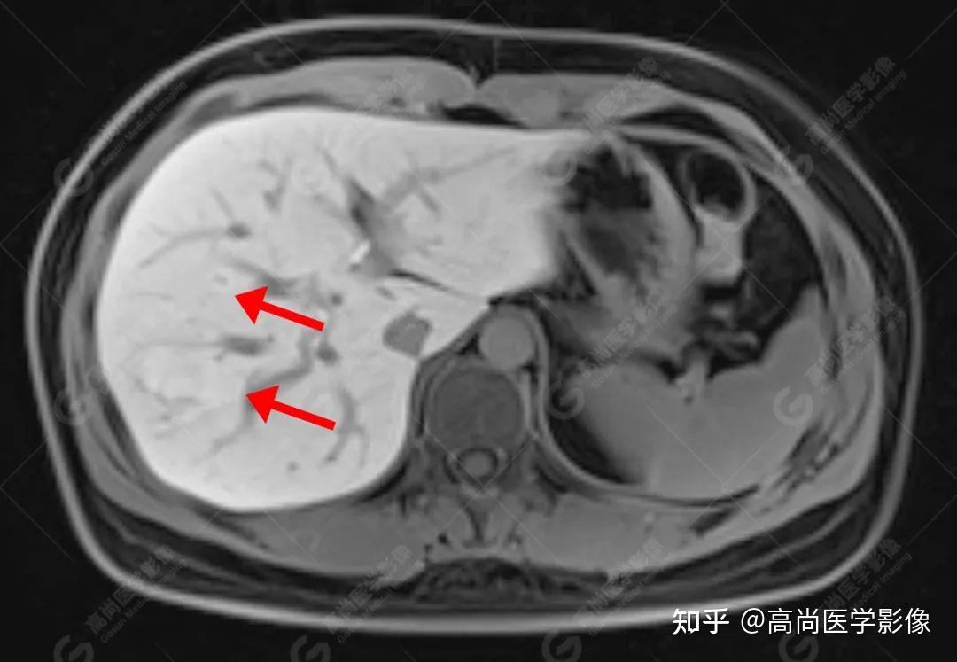 普美显在肝局灶性结节增生（FNH）的应用价值【高尚医学影像】 - 知乎