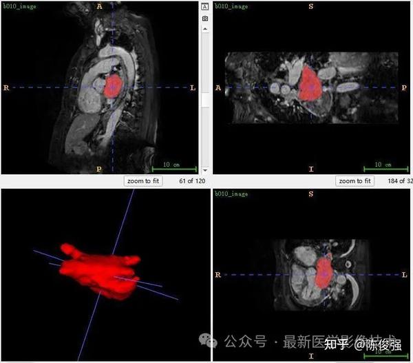 Left Atrial Segmentation Challenge 2013——MRI图像中的左心房分割 - 知乎
