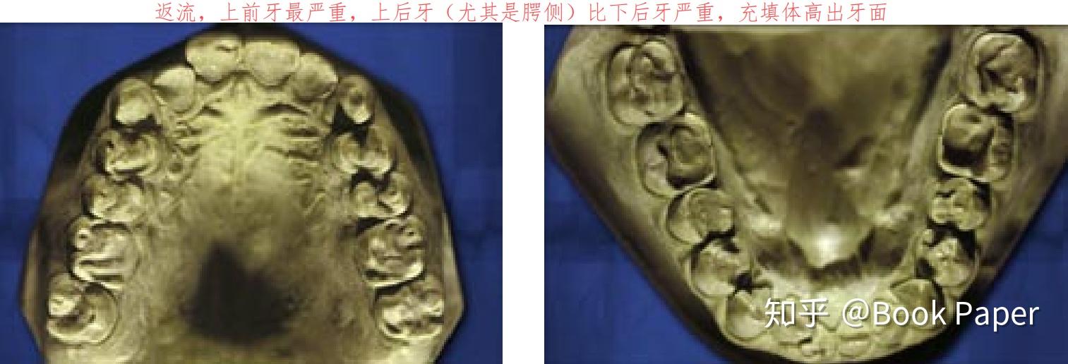 牙齿磨损——机械性及化学性磨损的病理模式 - 知乎