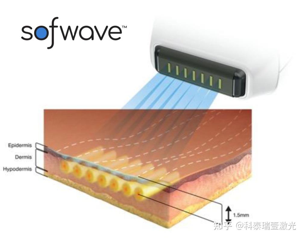 Sofwave（索芙波）你了解吗 - 知乎