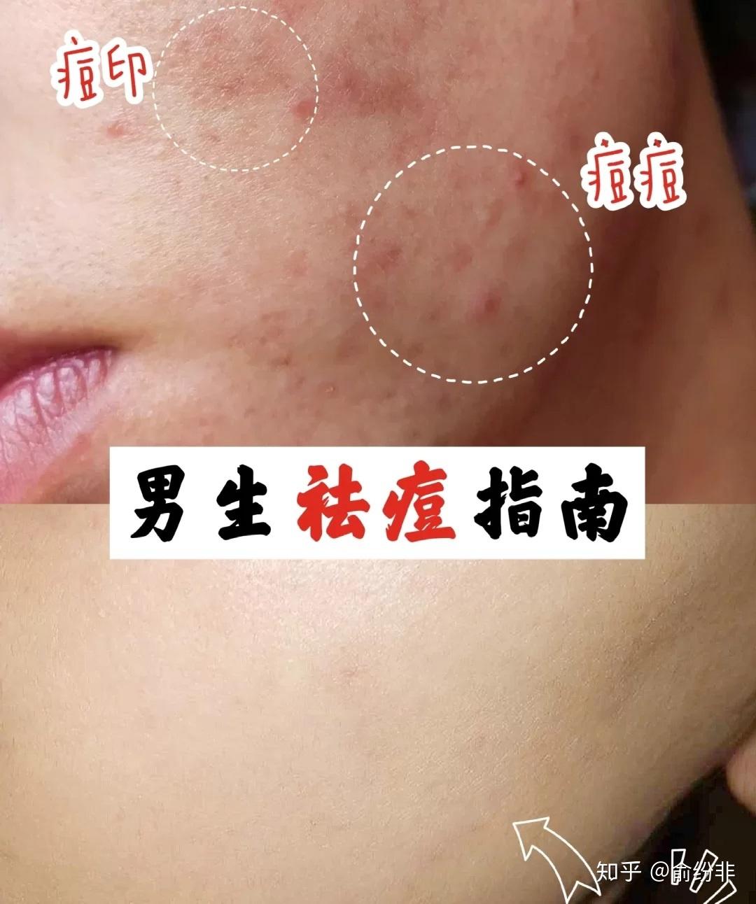如何祛痘和祛痘印 (我男的)? 知乎