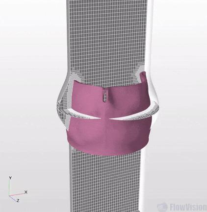 FlowVision在心脑血管生物力学CFD仿真分析的应用 - 知乎