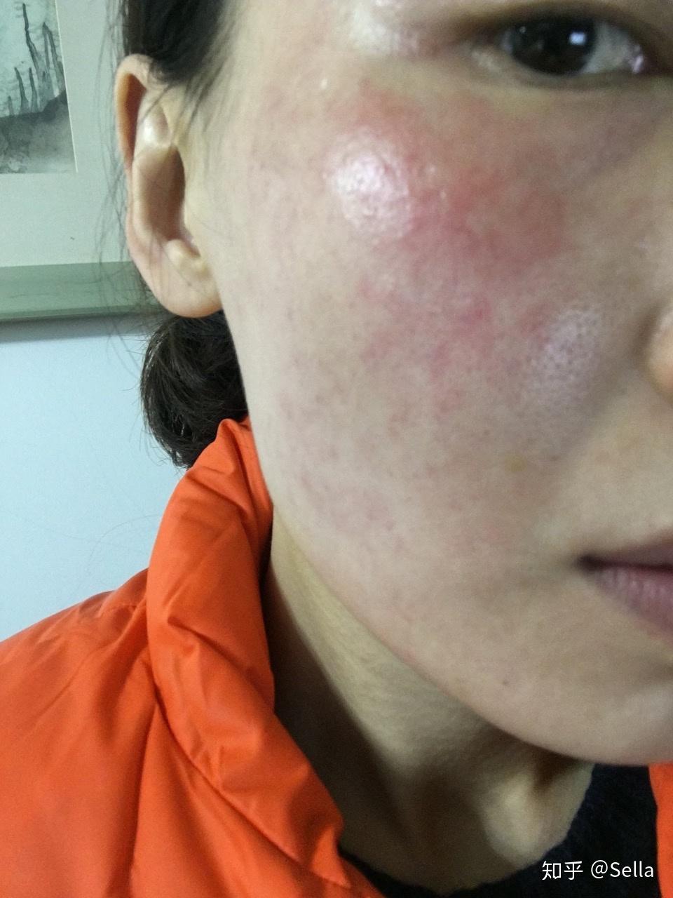 分享个简单的敏感肌抢救措施(亲测有效,纯分享!) 知乎