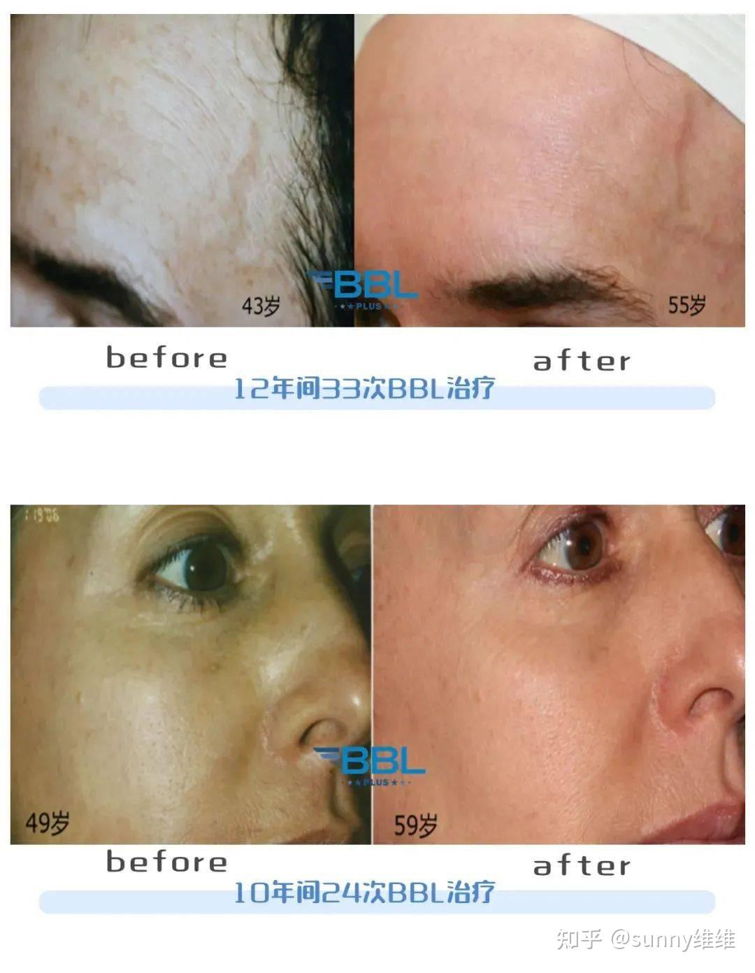 BBL PLUS到底做了哪些史诗级革新？一次说明白 - 知乎