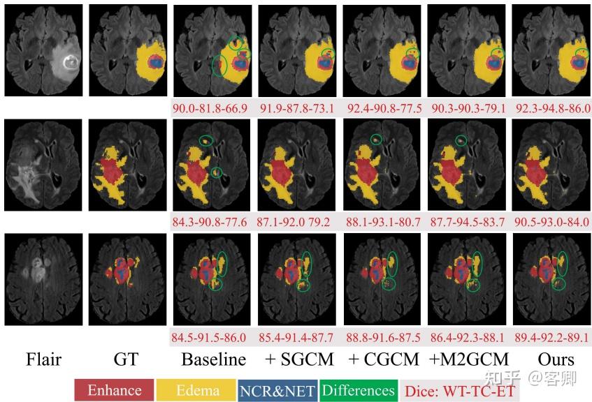 论文精读：多模态图卷积网络：用于跨多种磁共振序列精准分割脑肿瘤 - 知乎