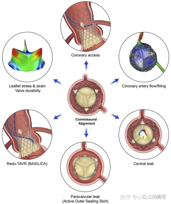 连合对齐（Commissural Alignment）：原理、定义、技术和结果（上） - 知乎