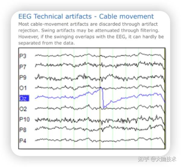 常见EEG伪迹波形图（基于analyzer分析软件展示） - 知乎