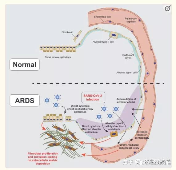 从 ARDS 到肺纤维化：COVID-19 大流行的下一阶段？ - 知乎