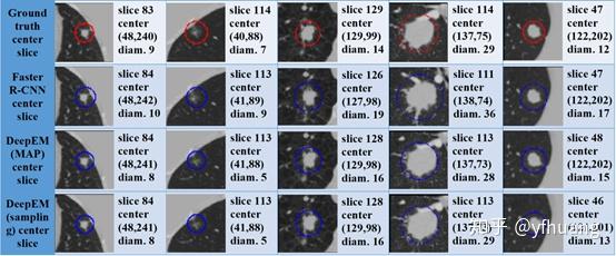 DeepEM: Deep 3D ConvNets With EM For Weakly Supervised Pulmonary Nodule Detection - 知乎