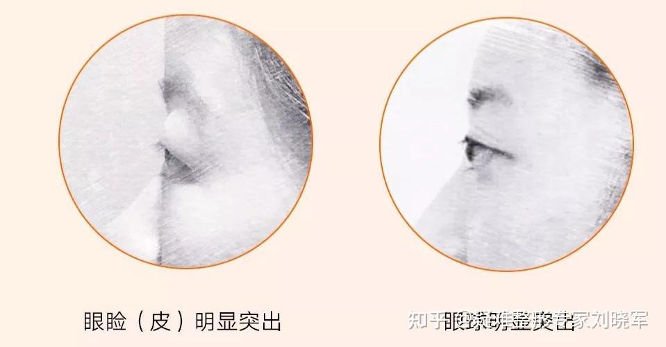 改善肿泡眼并不难，这4种方法建议收藏！ 知乎