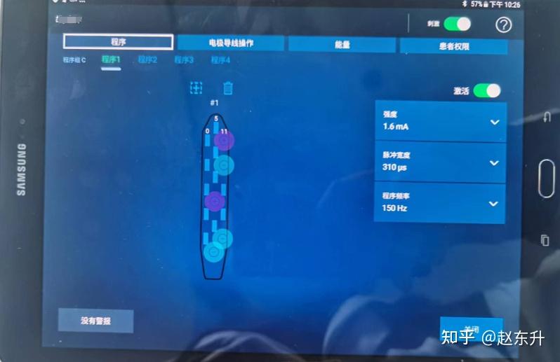 SCS脊髓电刺激疗法DTM™程控模式治疗25年右下肢顽固性疼痛 - 知乎