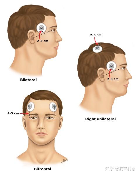 电休克治疗 - 知乎