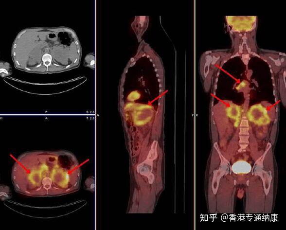DS-8201德喜曲妥珠单抗HER2基因非小细胞肺癌NSCLC - 知乎