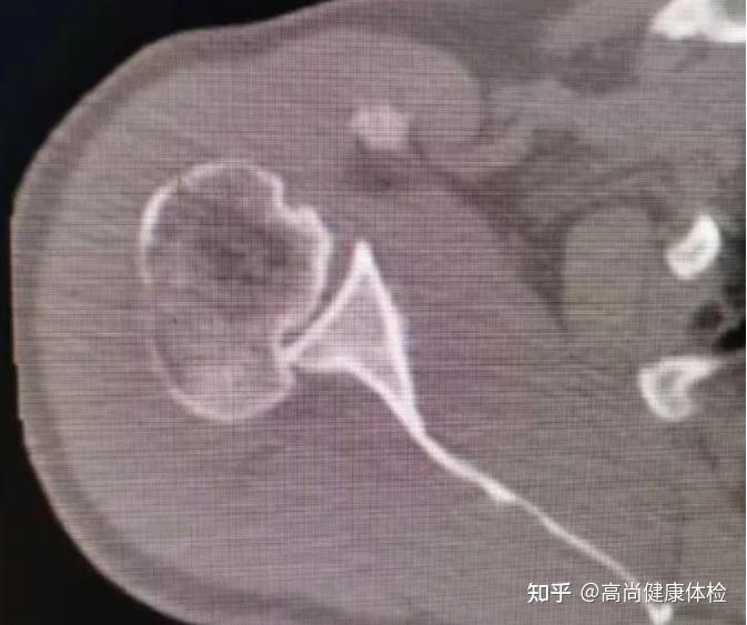 肩关节Hill-Sachs并Bankart损伤 - 知乎