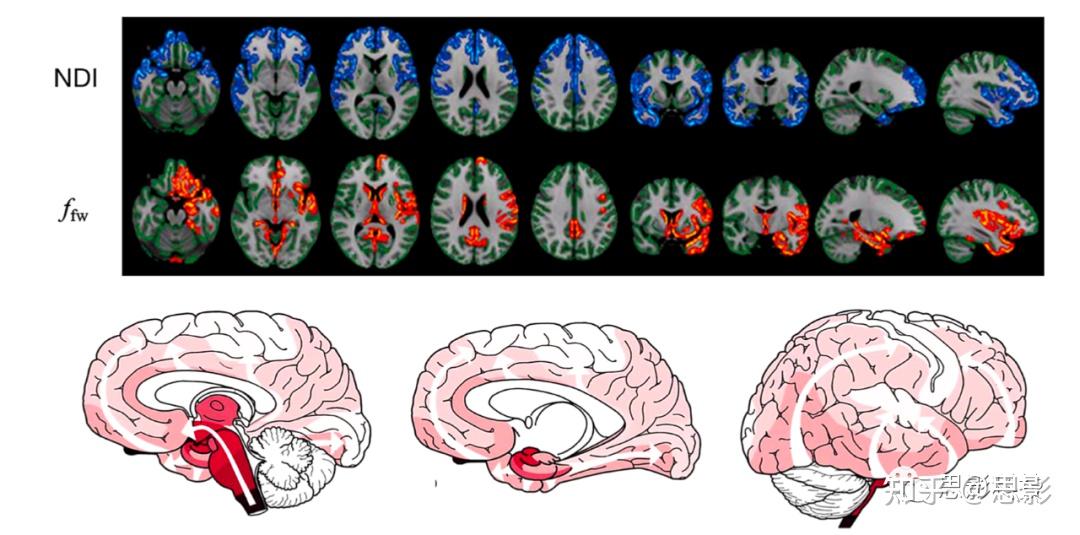 NODDI在临床研究中的应用 - 知乎