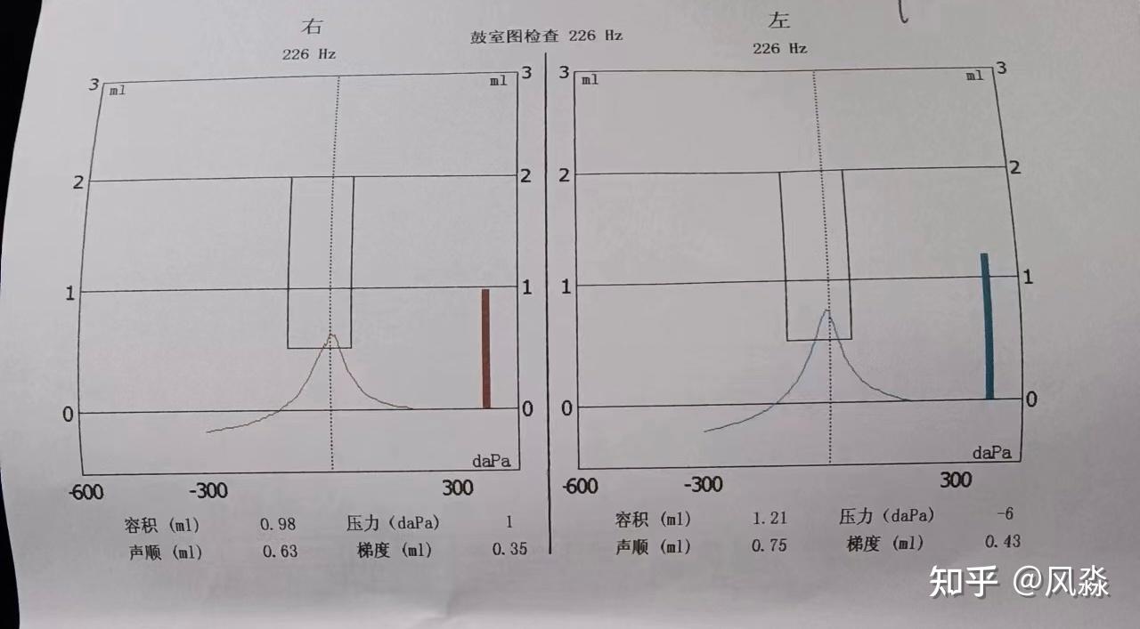 突发性耳聋记录——常更新 - 知乎