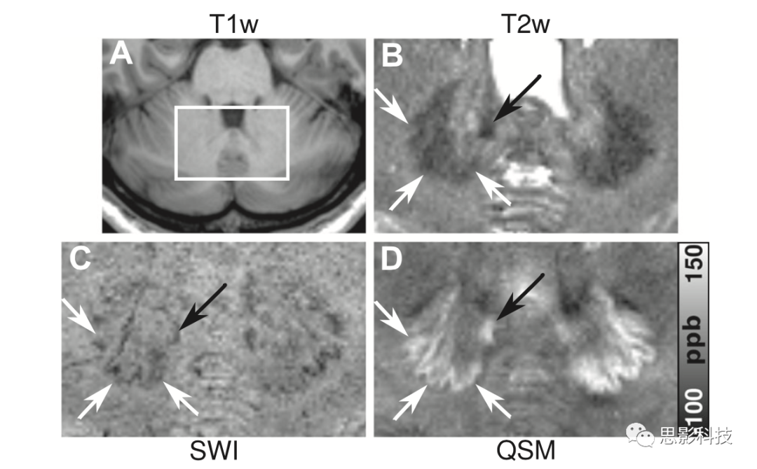 定量磁化率成像（QSM） - 知乎
