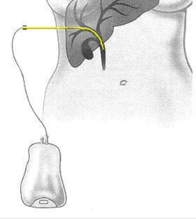 胆红素升高的严重程度分级和梗阻性黄疸的危险性、处理原则 - 知乎