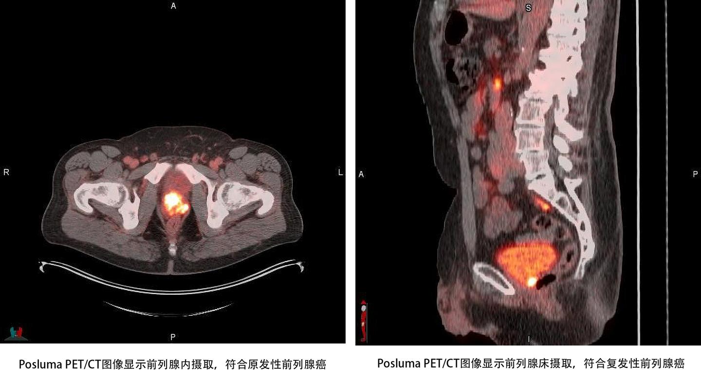 PSMA靶向显像剂Posluma获批用于辅助前列腺癌检测 - 知乎
