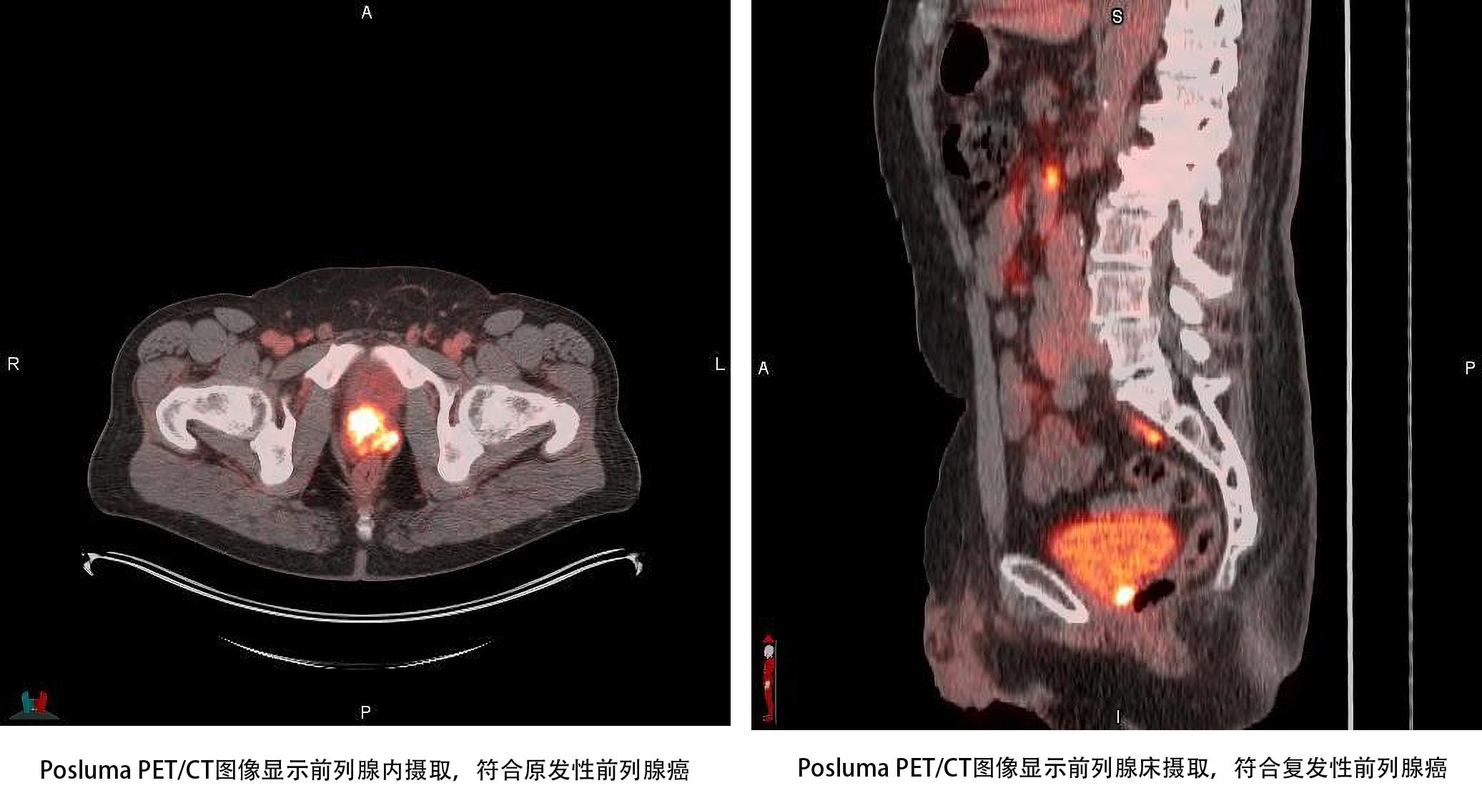 PSMA靶向显像剂Posluma获批用于辅助前列腺癌检测 - 知乎