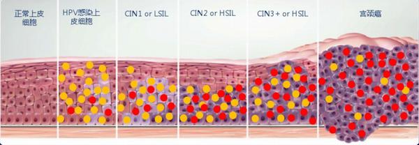 CIN1、CIN2、CIN3、AIS等关键宫颈癌指标辨析 - 知乎