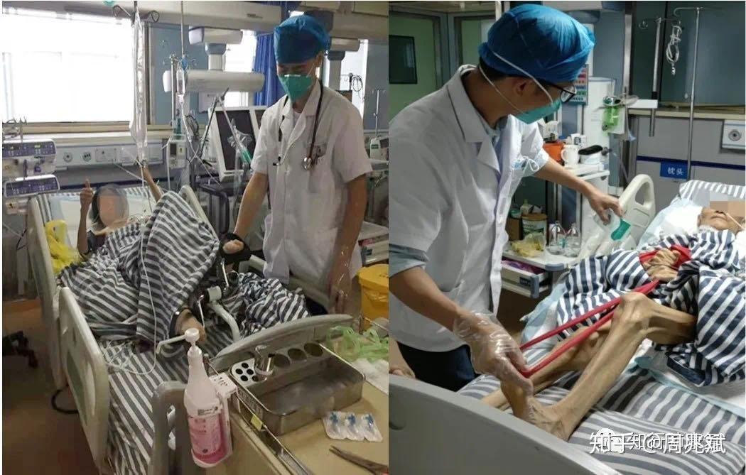 ICU-AW的影响及康复治疗 - 知乎