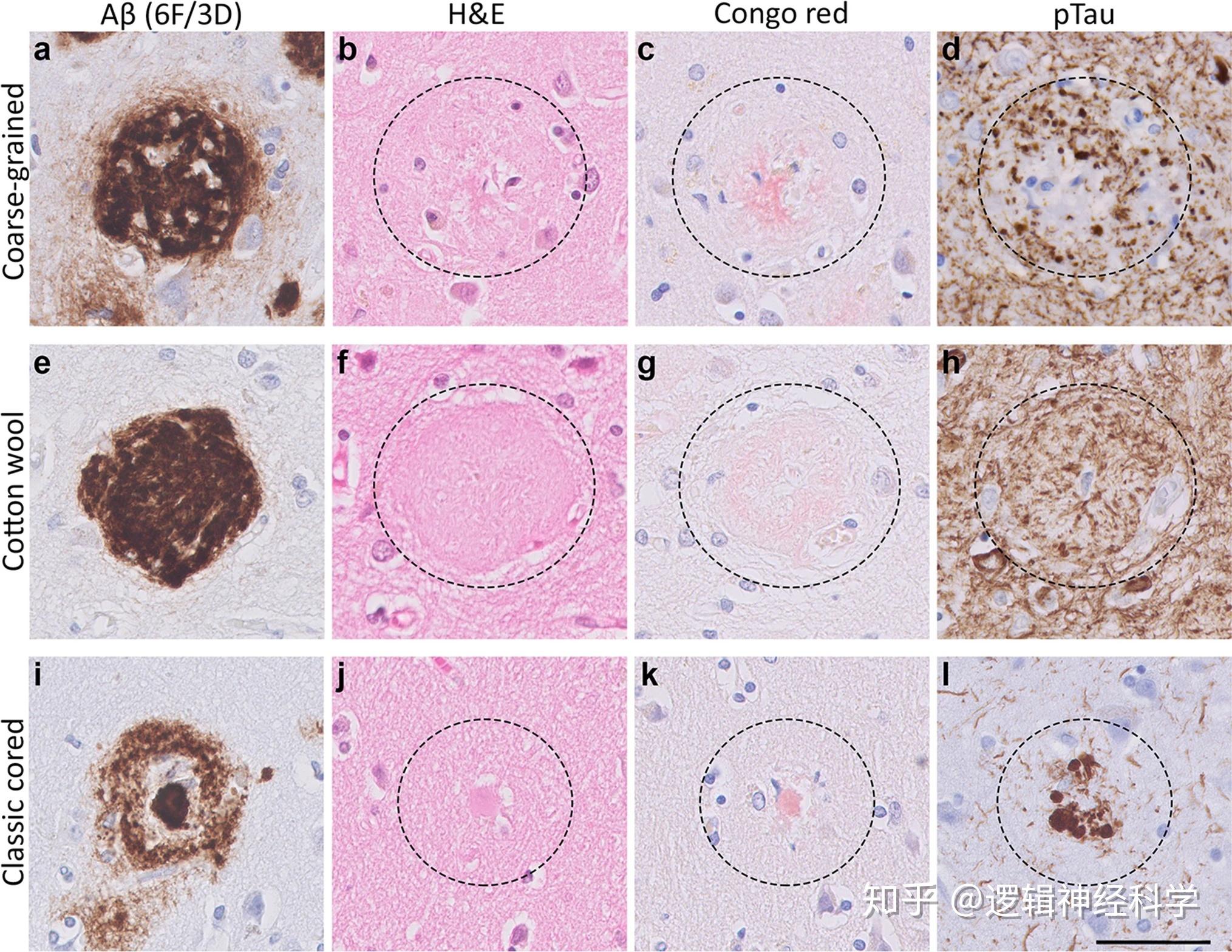解读Acta Neuropathologica︱早发性AD中的一种特殊斑块: 粗糙-颗粒状斑块 - 知乎