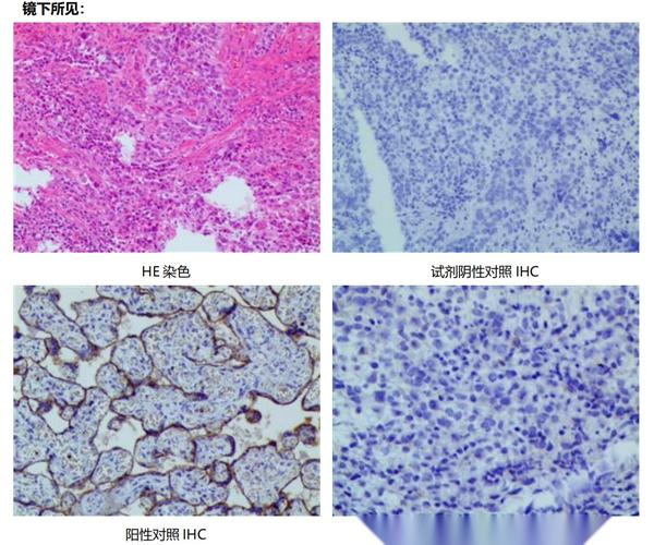教你解读PD-L1表达检测结果！ - 知乎