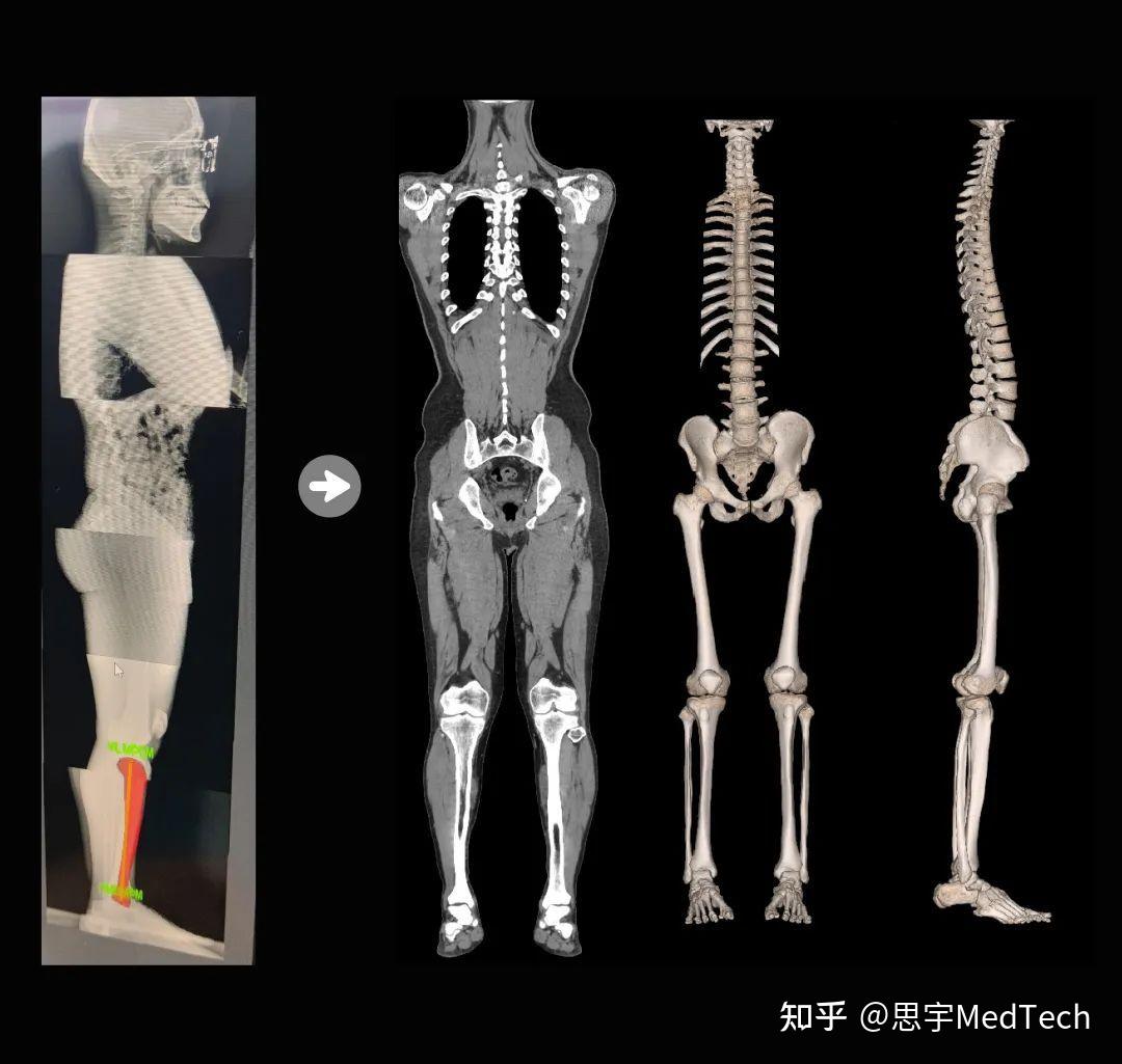 闪耀COA2024，赛诺威盛站立位CT影像解决方案开启骨科影像新纪元 - 知乎
