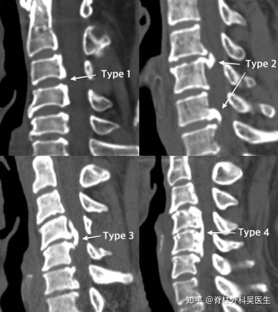 颈椎后纵韧带骨化保守治疗时，哪些危险因素会导致其进展？ - 知乎