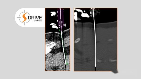 XACT远程控制系统获得FDA许可 - 知乎