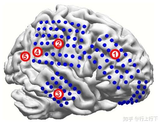 颅内脑电图简介 - 知乎