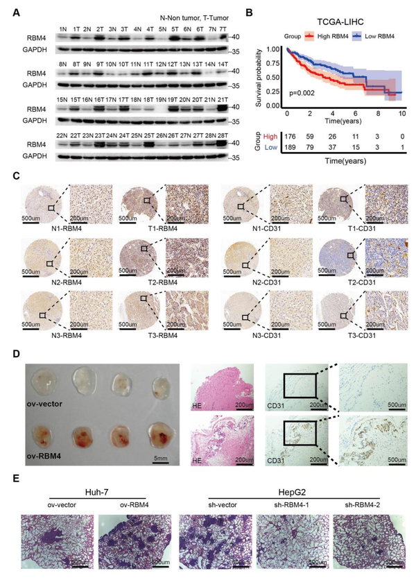 Pharmacol Res | 周国雄/叶军团队研究发现RBM4通过选择性激活VEGF-A的表达来促进肝癌中的血管生成 - 知乎