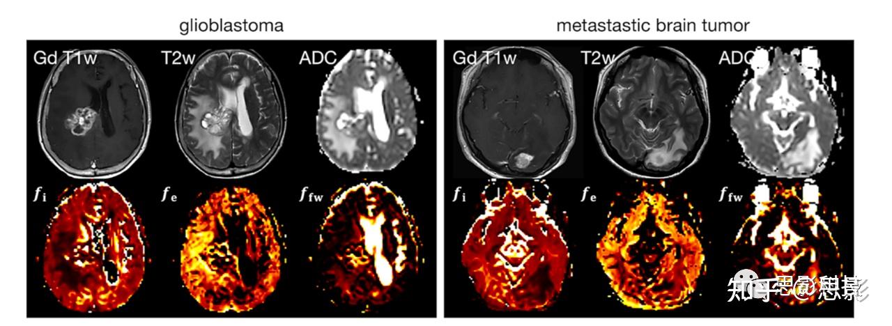 NODDI在临床研究中的应用 - 知乎