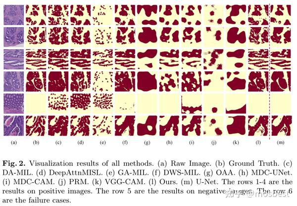 Transformer based multiple instance learning for weakly supervised ...