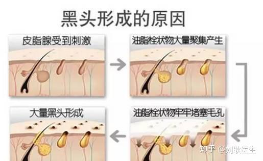 为什么黑头总是反反复复？该如何去除黑头？ 知乎