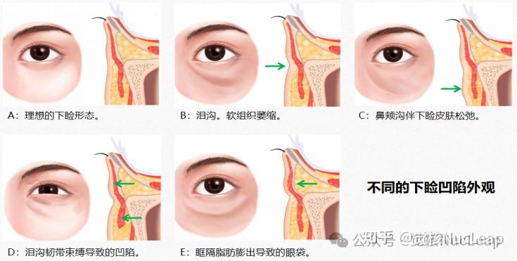 泪沟填充全面解析：从解剖层次、注射技法到风险规避，一篇讲透 - 知乎