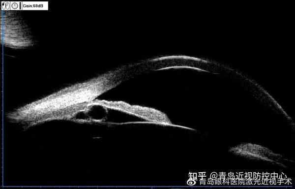 ICL晶体植入术前和术后要做哪些检查？一次说明白 - 知乎