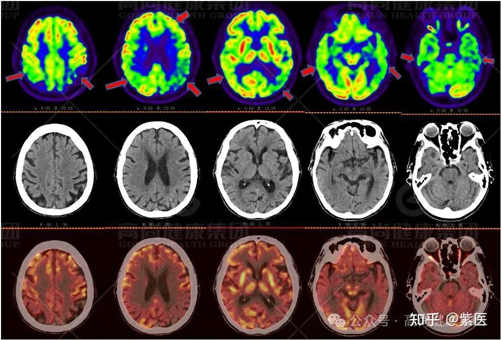 学术荟萃系列专题 | PET脑成像在阿尔茨海默病的应用价值 - 知乎