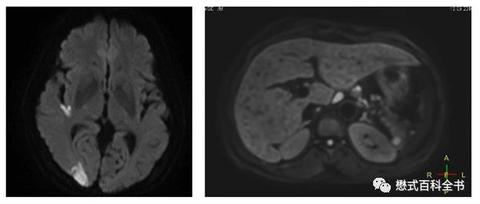 IRIS：多激发SE-EPI扩散（弥散）序列 - 知乎