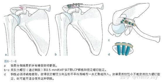 锁骨骨折的治疗原则 - 知乎