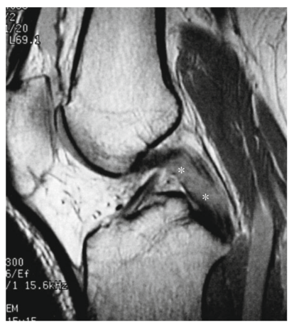 自信诊断-后交叉韧带撕裂磁共振表现 - 知乎