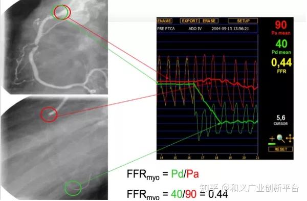 血流储备分数2——一文了解，FFR、FFRct技术原理、特点及应用 - 知乎