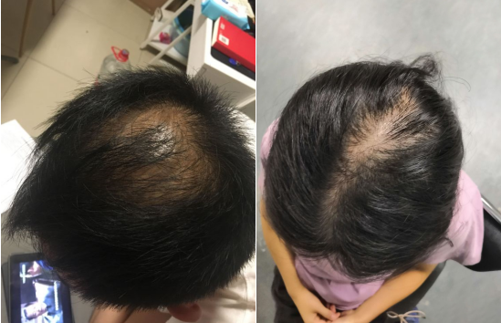 头顶脱发严重，稀疏见头皮马上秃顶？3种方法教你恢复发量 知乎